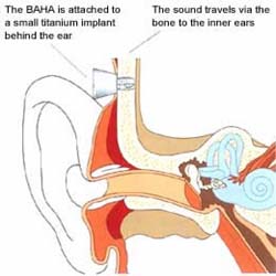 Bone-Anchored Hearing Helpful For Kids With Single-Sided Deafness | TopNews